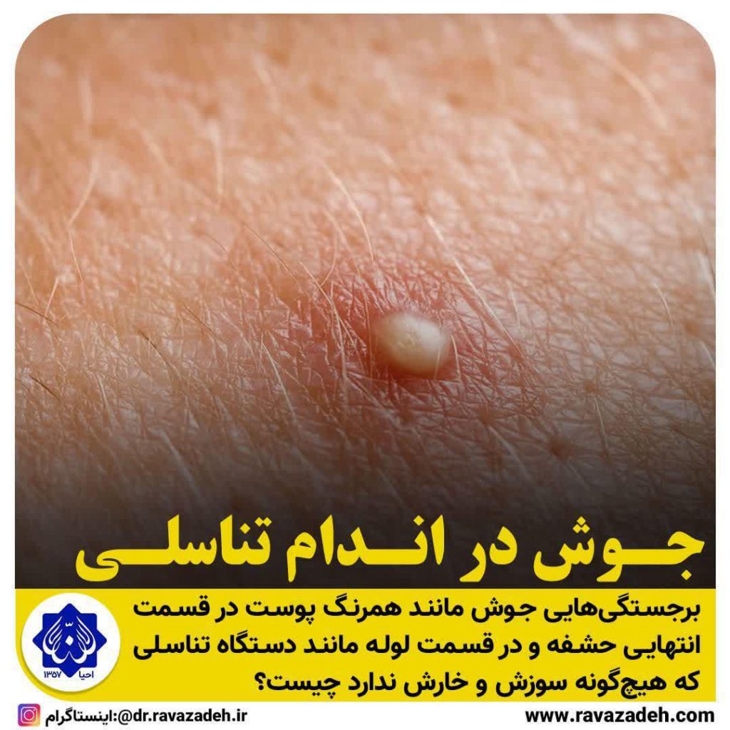 جوش در اندام تناسلی روازاده سایت حکیم دکتر روازاده پدر طب ایرانی اسلامی